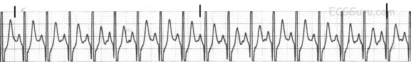 ECG Basics: Sinus Tachycardia vs. PSVT | ECG Guru - Instructor Resources ECG Basics: Sinus Tachycardia vs. PSVT | ECG Guru - Instructor Resources